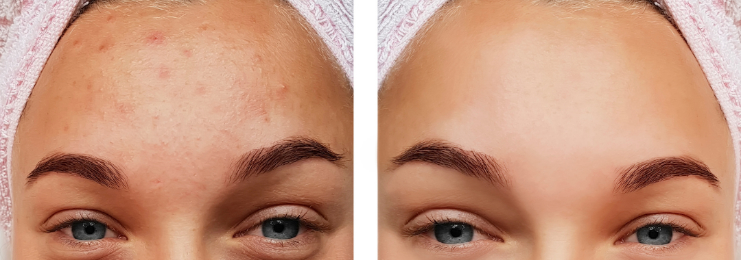 Top Tips For Managing Acne