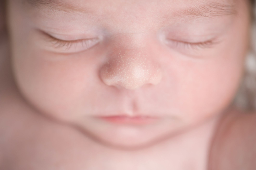 BABY MILK SPOTS EVERYTHING YOU NEED TO KNOW BABY MILK SPOTS EVERYTHING YOU NEED TO KNOW
